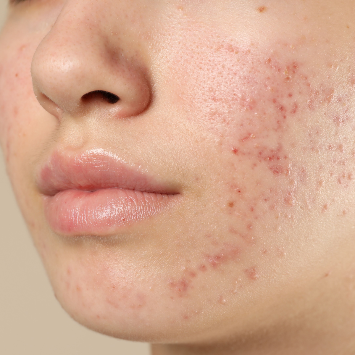 Huidaandoeningen – NovaPellis